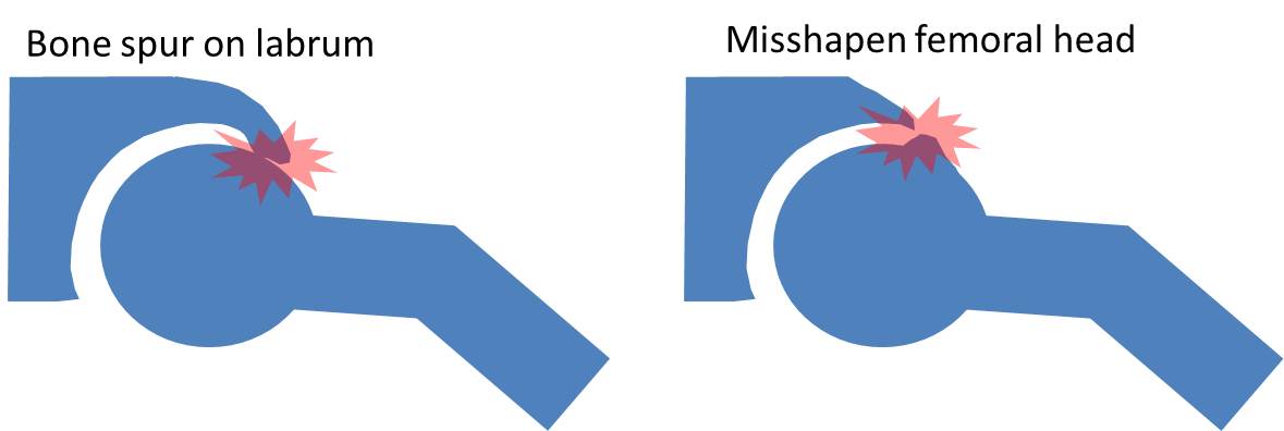 Fai hip injury symptoms knee, muscle pain around the hip area code ...